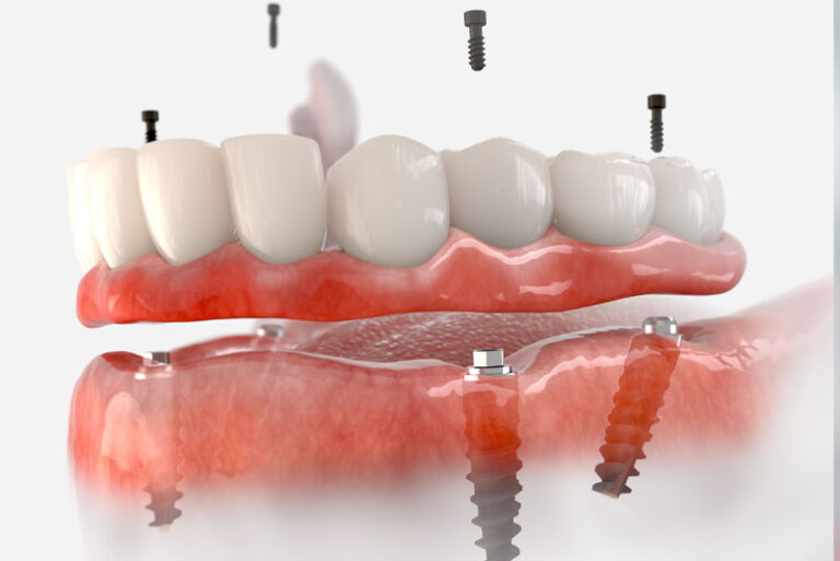 Are Dental Implants Permanent? Dentures vs Fixed Teeth Near Me